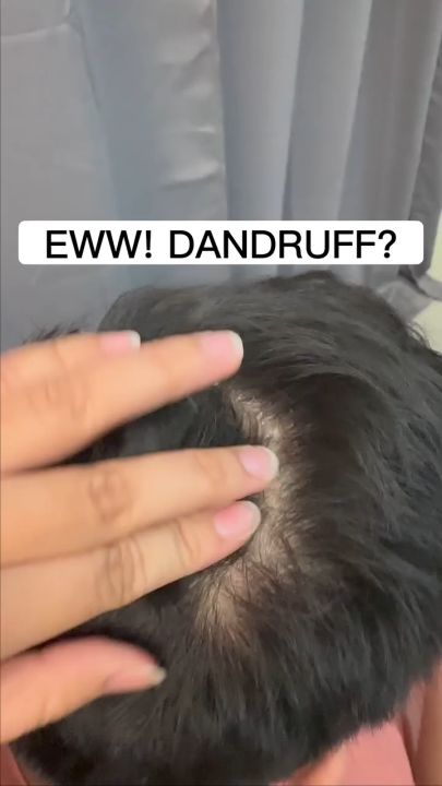 Zero Flakes | Anti Dandruff Remover, Anti-Fungal & Anti Itch | Hair Oil ...