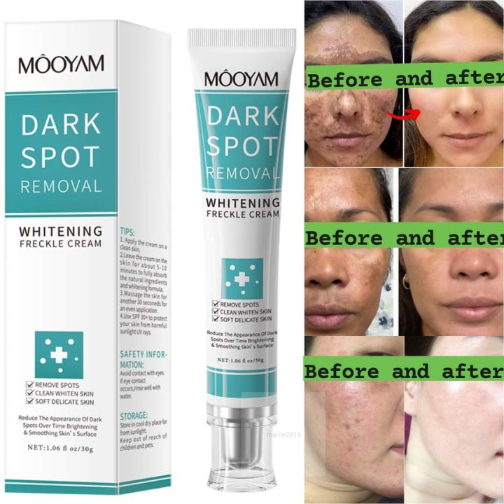Strong cream removal for melasma, dark spots, freckles and ...