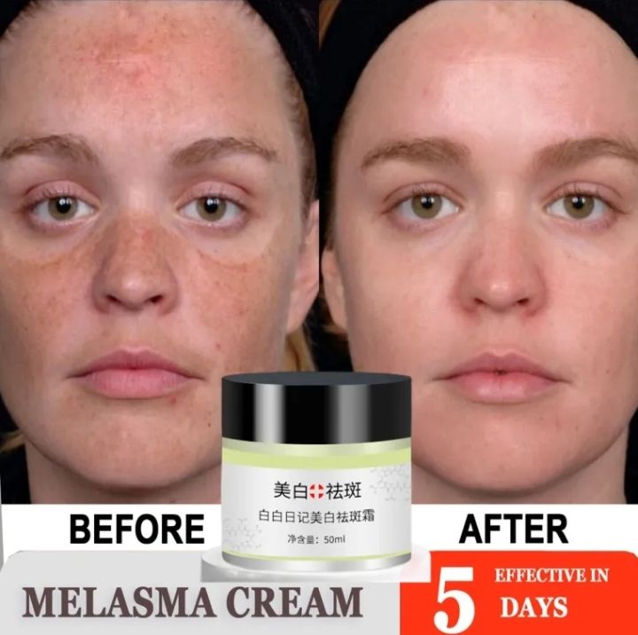 Melasma Cream japan | Lazada PH