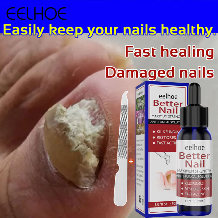 Eelhoe Fungal Nail Repair Essence Foot Toe Nail Anti-Fungal Solution ...