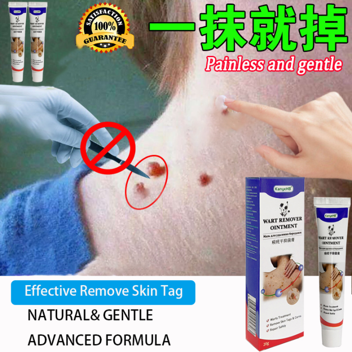 skin tag remover cream warts remover original cream Papillomas Mole ...