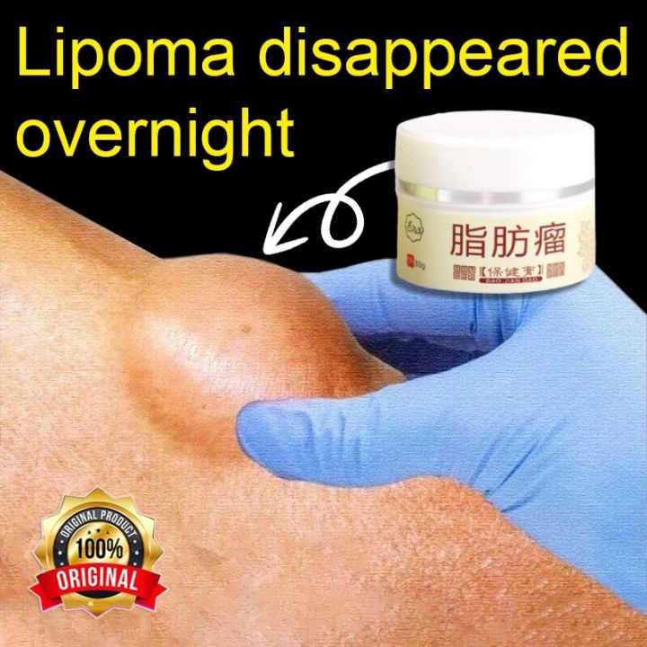 Lipoma removal Cream lipoma cream 脂肪瘤 30g Fat Granule Care Removing ...
