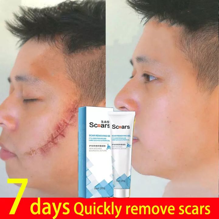 100% Effective Scar Remover for Old Scar on Leg Scar Gel Stretchmark ...