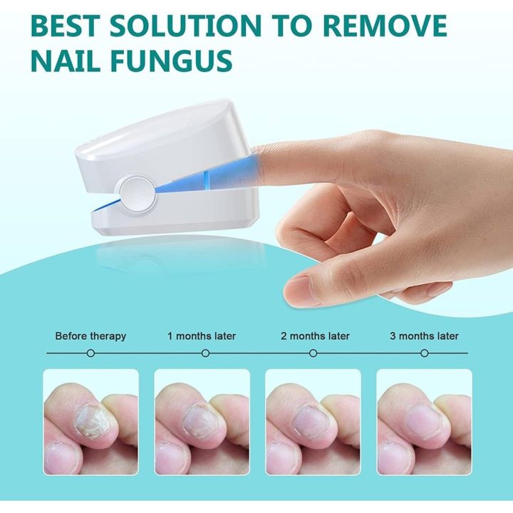 Rechargeable Nail Fungus Remover Toenail Fungus Cleaning Laser Device ...