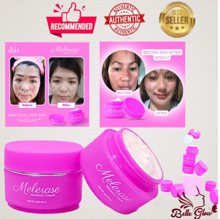 Melerase ( Melasma, Pekas , Severe Acne, Pimples and Freckles Remover ...