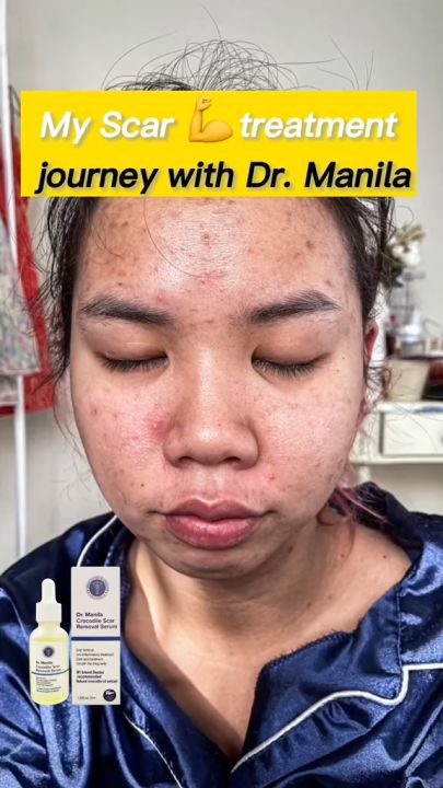 Dr.Manila - Crocodile Scar Removal Serum | Melasma Treatment Serum ...