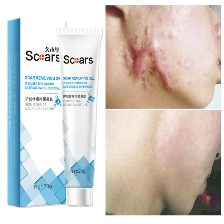 Original Effective Scar Removal Cream for Old Scar on Leg Stretch Mark ...