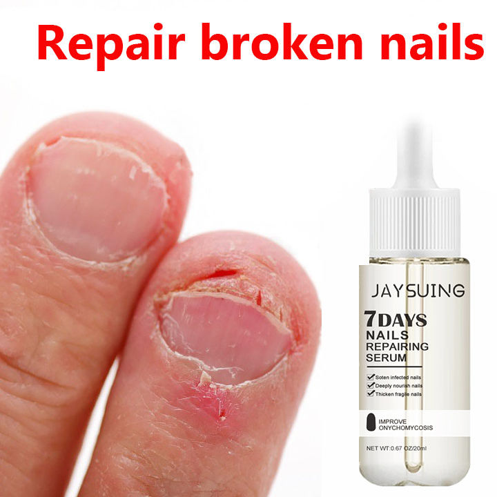 Nail Fungus Treatments Serum Repair Toe Nail Fungal Removal Essence Anti-Infection Onychomycosis ...