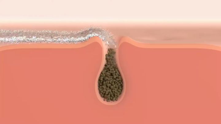 PanOxyl Acne Foaming Wash Benzoyl Peroxide 10% Maximum Strength ...