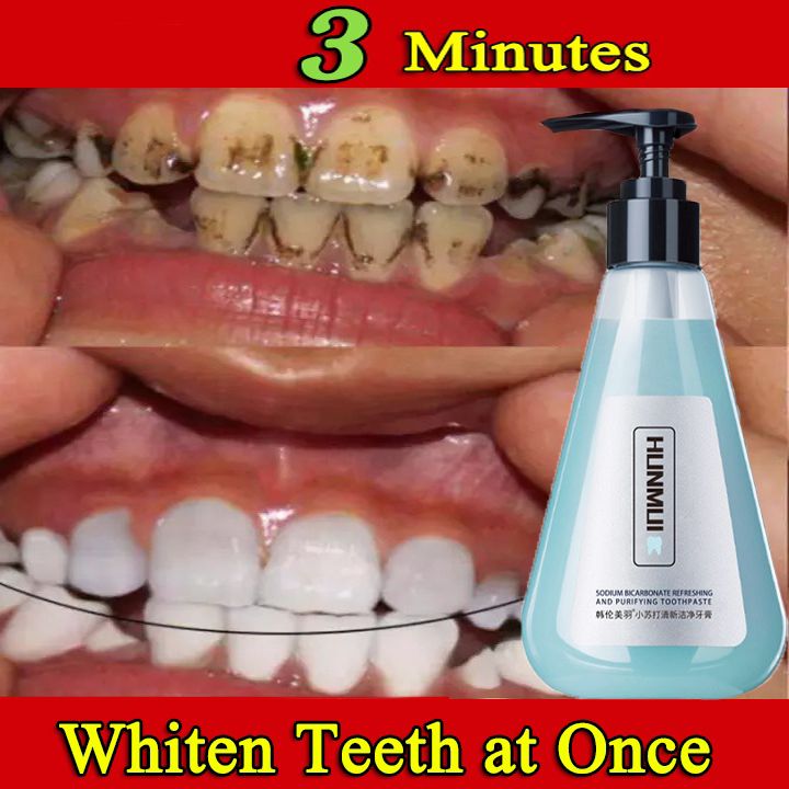 [ FREE SHIPPING FEE ] (WHITENING TEETH # 1) New 210g HUNMUI Sodium ...