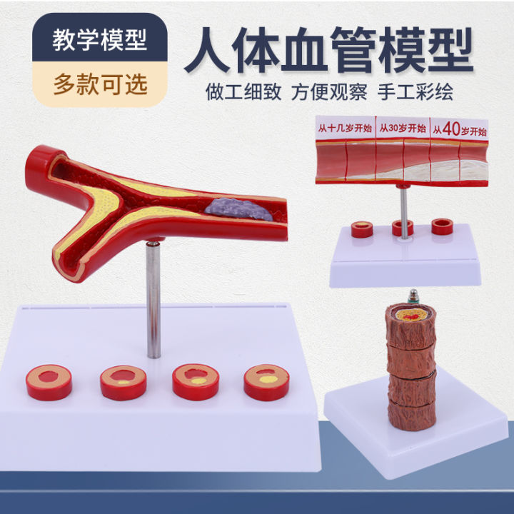 Heart Disease Model Cardiovascular System Plug Degree Change ...