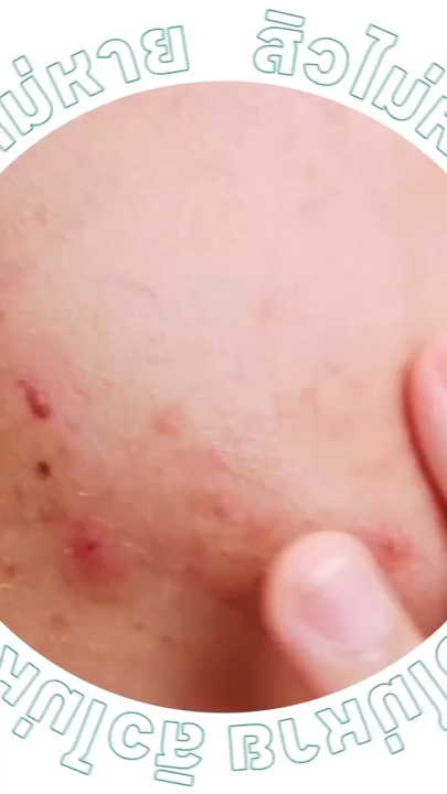 Benutra Acno Pro บีนูทร่า แอคโน โปร วิตามินดูแลสิว ซิงค์ดูแลสิว สิว ...