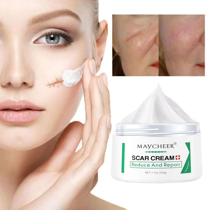 100% Original MAYCHEER Scar Cream Remover Peklat For Old And New Scar ...