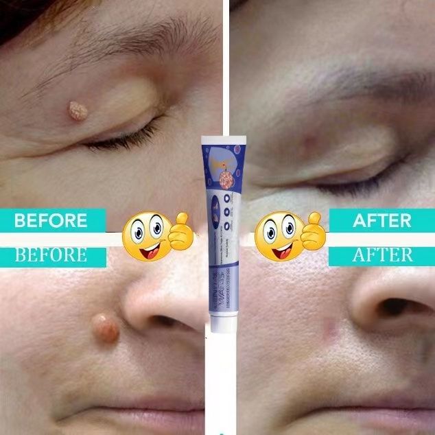 ubat buang ketuat kaki anti wart removal cream wart remover ointment ...