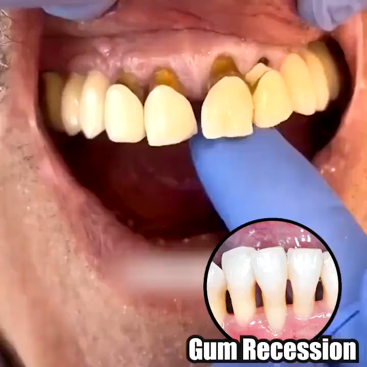 Gum Therapy Gel Teeth Repair Gel Instant Soothing Gel loosening ...