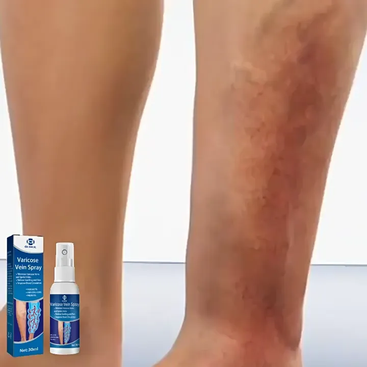 Ouhoe Vein Spray Relieves Vein Care Varicose Vein Bulge Vein Massage ...