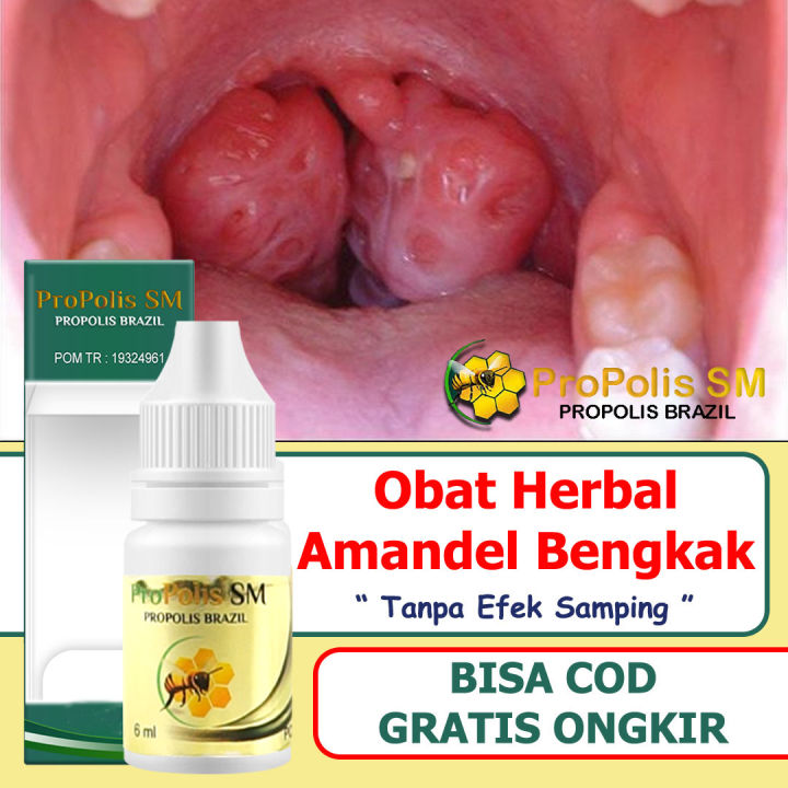 Obat Amandel Anak Dan Dewasa - Radang Amandel - Obat Amandel Bengkak ...