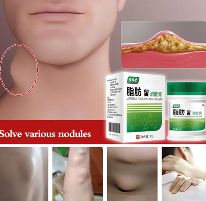 Fat health cream Subcutaneous hard lump fibroma cream Fatty tumor ... Fat health cream Subcutaneous hard lump fibroma cream Fatty tumor ...