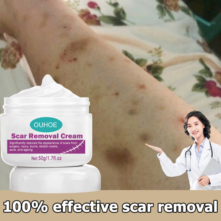 Genuine scar removal cream, scar removal, stretch marks scar removal ...