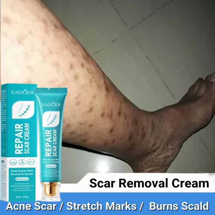 Scar Remover Cream 20g Scar Repair Gel Remover Cream For Legs Peklat ...