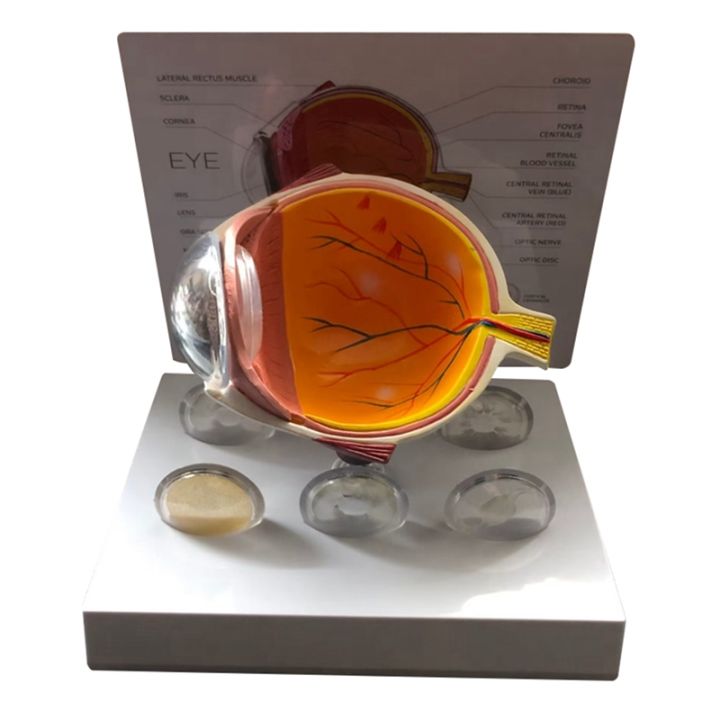 Eyeball Model Human Eye Demonstration Glaucoma Cataract Anatomy Medical ...