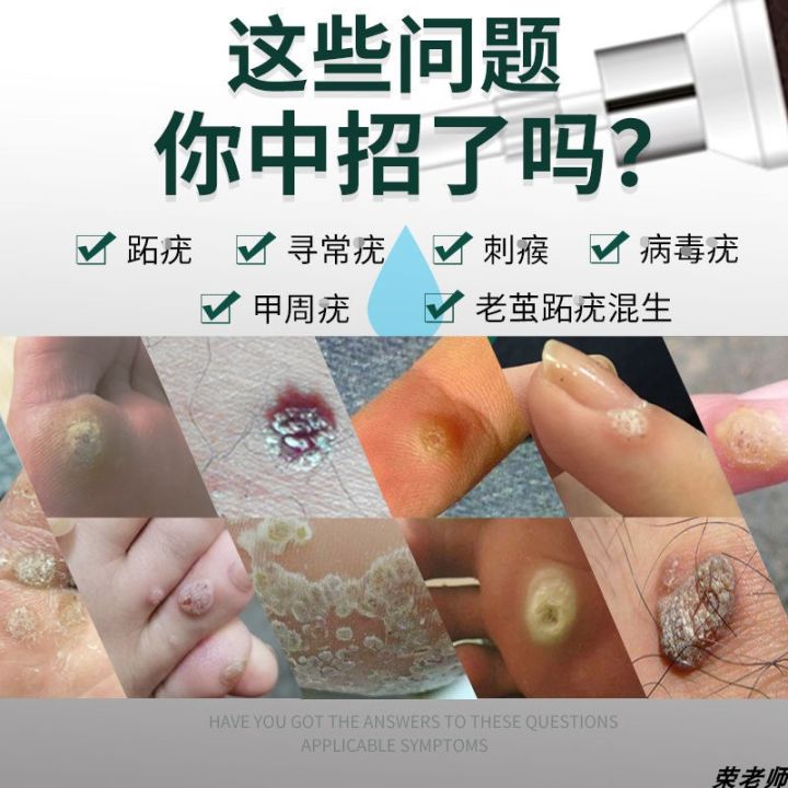 Special foot corns paste for curing wart, especially small pimple ...