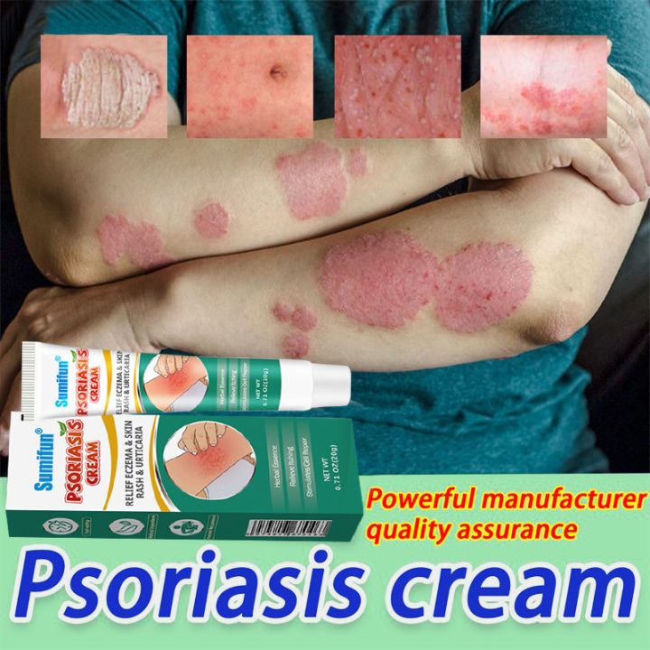 3Days Effective Psoriasis Ointment Psoriasis Eczema Cream Psoriasis Treatment Cream for Itchy ...