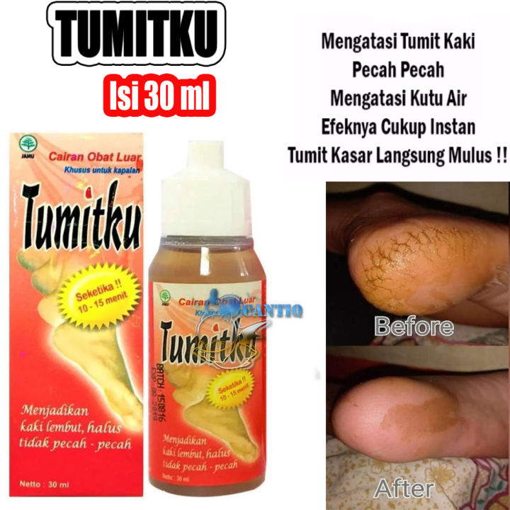 QCF 1 PCS TUMITKU Obat Kaki Pecah - Pecah BPOM 30 ML Solusi Tumit ...