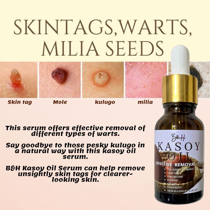 B&H KASOY OIL SERUM WARTS KULUGO REMOVAL | Lazada PH