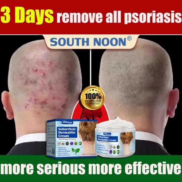 Obat Kepala Borok, Kulit Kepala Berkerak Dan Bersisik, Ketombe Parah, Korengan, Infeksi Jamur ...