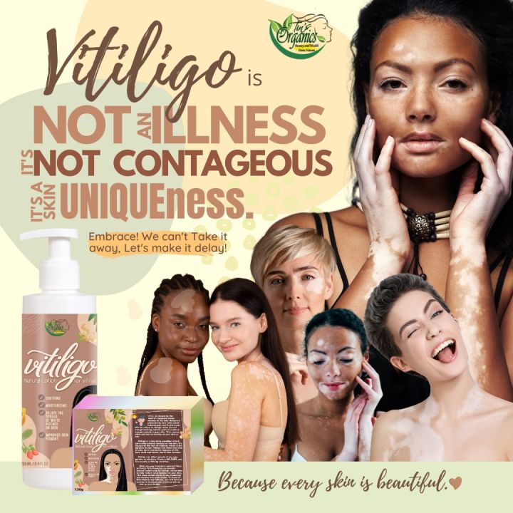 VITILIGO TREATMENT SOAP & LOTION | Lazada PH