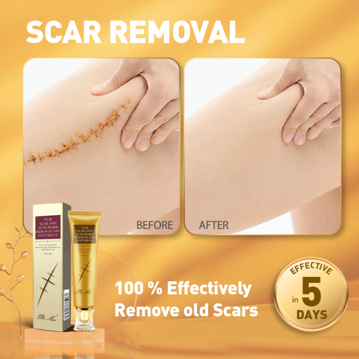 scars remover for old scars fix scar removal original peklat remover ...