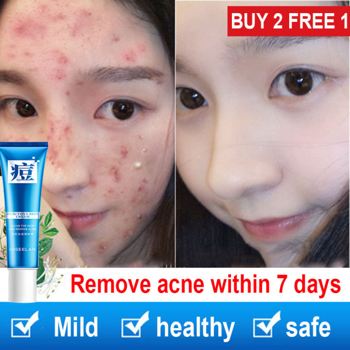 Facial Acne Removing Cream Acne Removing Cream Acne Removing Cleaning ...
