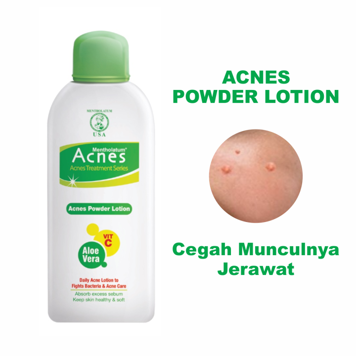 Acnes Treatment Series Oil Control Acnes Powder Lotion Acne Treatment ...