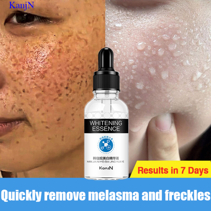 Melasma and pekas remover serum, melasma removal cream original ...