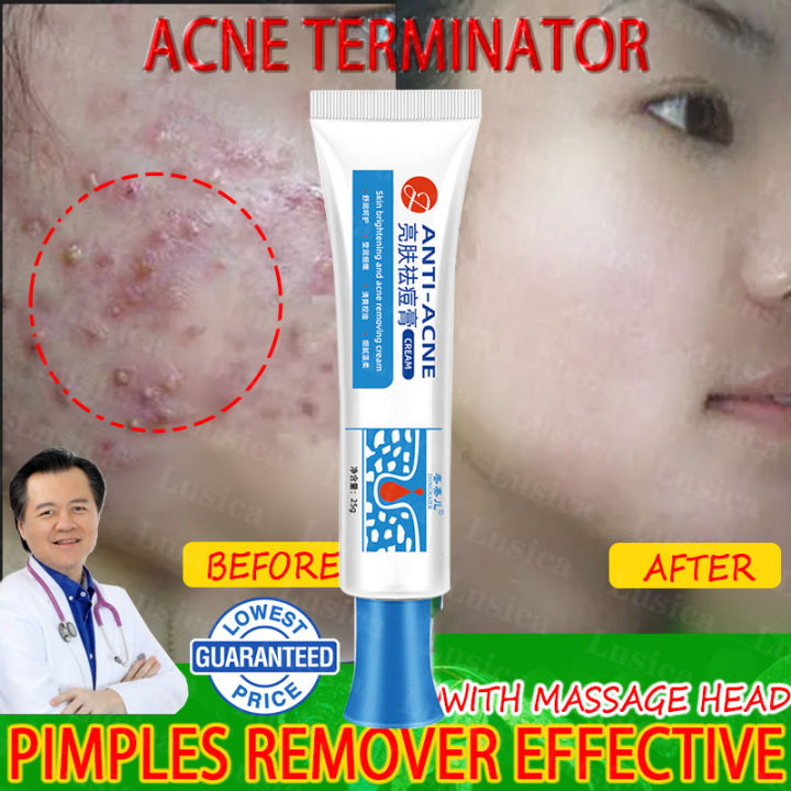 Original Acne Scars Remover for Face Pimples Remover Best Seller Scar Gel Pimple Quickly Marks ...