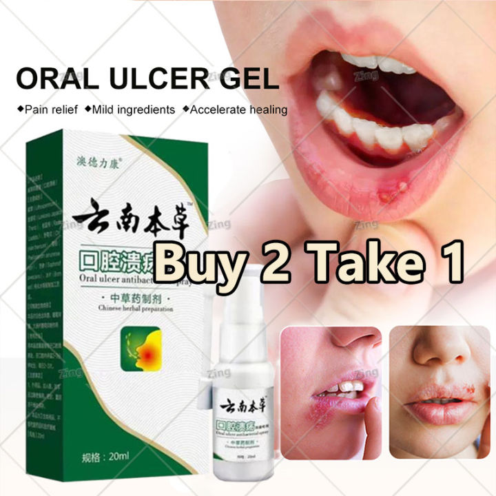 【Buy 2 Take 1，Buy 4 Take 2】canker mouth sore solution mouth ulcer ...