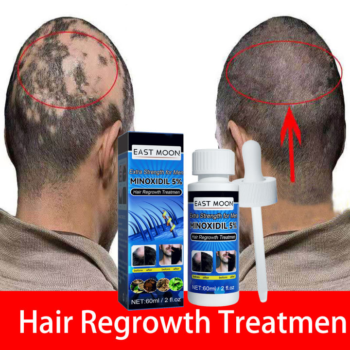 ⚡thicker Hair In 7 Days⚡ Minoxidil Hair Grower For Men Original Regrow