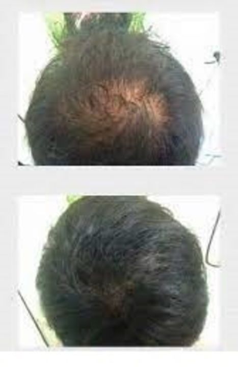 Retan 5 บำรุงรักษาเส้นผม ลดผมร่วง คิ้ว กระตุ้นการงอก หนวด เครา สารอาหาร ...