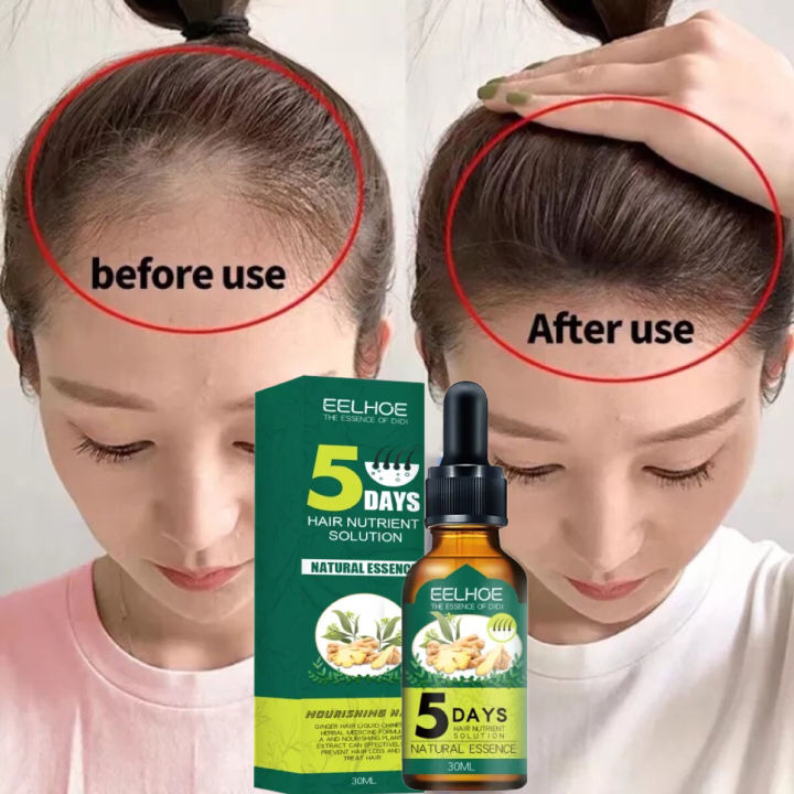 EELHOE Obat Penumbuh Rambut Anti Rontok / Obat Rambut Botak Ginger ...