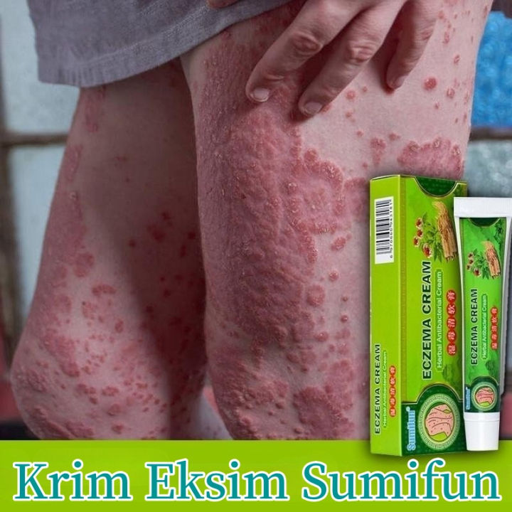 Salep gatal Salep Eksim Salep kulit Krim psoriasis paling ampuh Kulit ...
