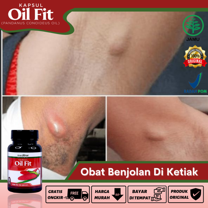 Obat Benjolan Di Ketiak Herbal, Obat Kelenjar Membengkak Di Ketiak ...