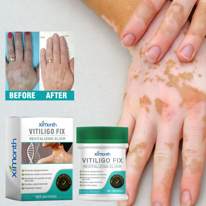 Ximonth White Spot Repair Cream 15g Remove Ringworm White Spot Removal ...