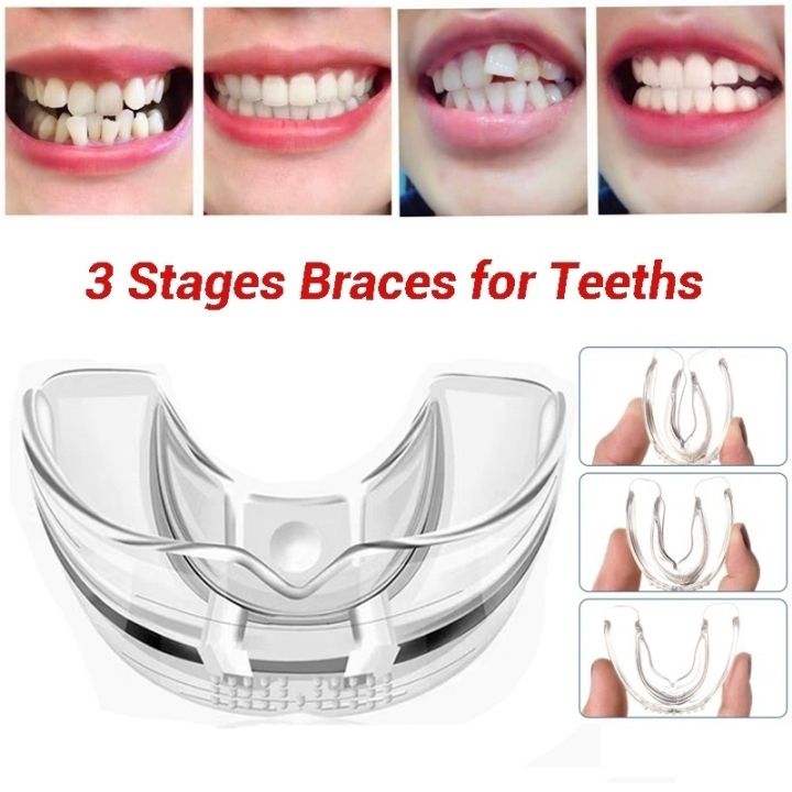 SMILEKIT Teeth Alignment 3 Stages Teeth Ratainer Teeth Straightener ...