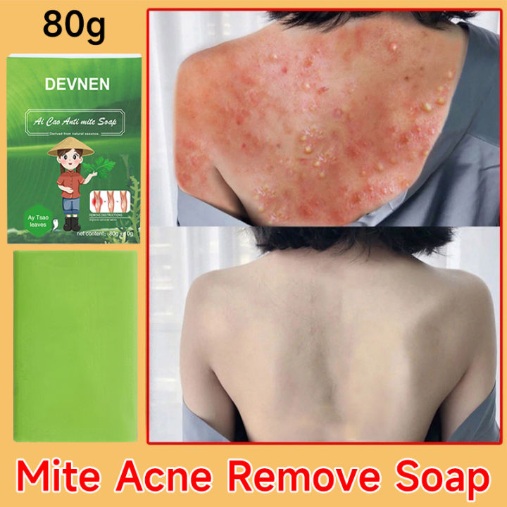 DEVNEN Antibacterial Soap AntiAcne, AntiFungal, AntiBacterial ...