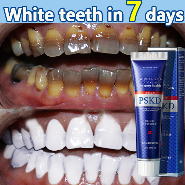Korea Teeth Whitening Mousse Toothpaste Cleansing Teeth Mousse Remove ...