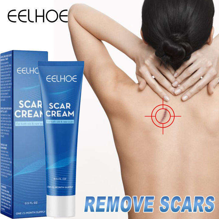 【100% EFFECTIVE】Scar remover for old scar Remove Stretch Mark Scar Scar ...