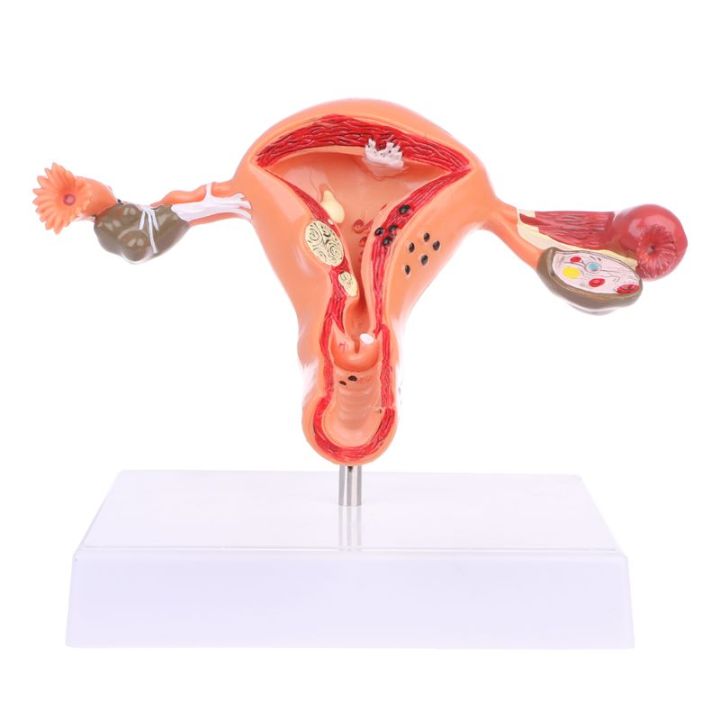 Pathological Uterus Ovary Anatomical Model Anatomy Cross Section Study ... Pathological Uterus Ovary Anatomical Model Anatomy Cross Section Study ...