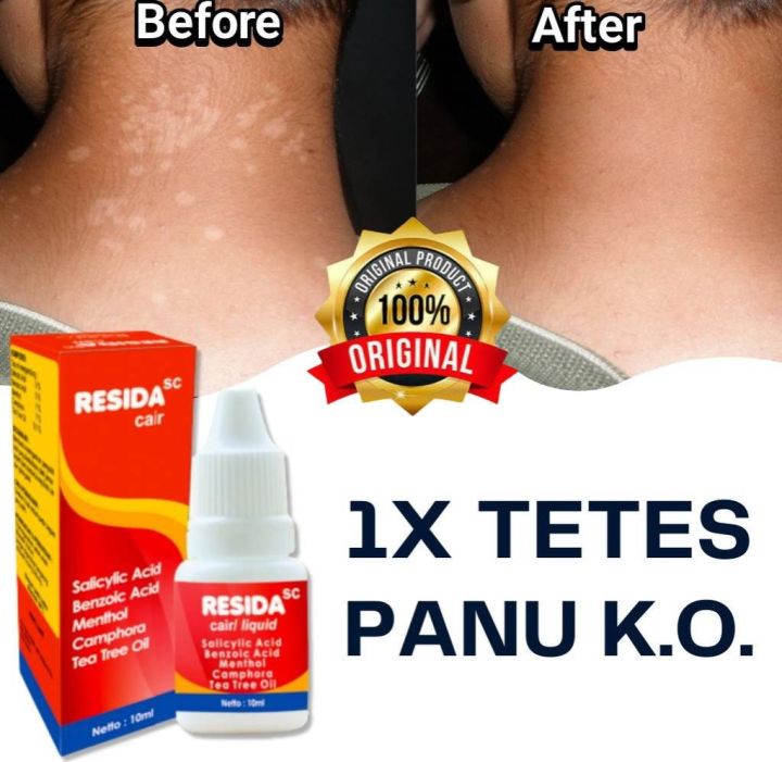 Obat Panu Ampuh 100% Resida Cair, Obat Kulit Panu Kadas Kurap Kudis dan ...