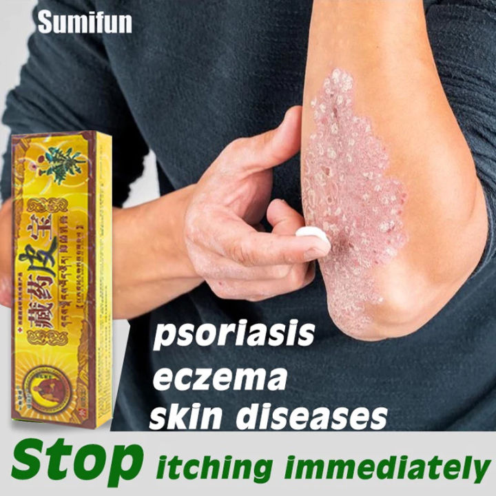 Eczema treatment cream Psoriasis cream skin itchy cream Antibacterial ...